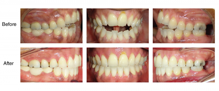 INNOVATION | CTOR Plates: A new invention for non-surgical treatment of ...