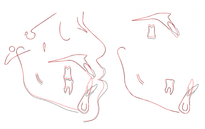 INNOVATION | Non-surgical treatment of severe open bite using CTOR Plates